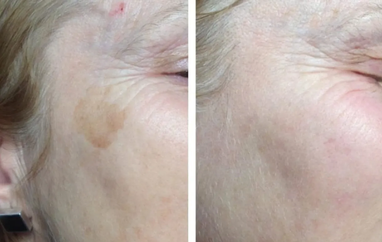 Macchie scure e lentigo solari - Dott. Nino Favoriti